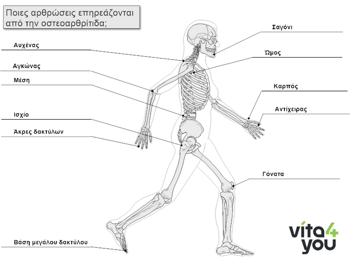 Ποιο είναι το καλύτερο συμπλήρωμα για οστεοαρθρίτιδα!