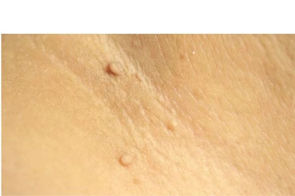 Θηλώματα: Tι είναι και γιατί βγαίνουν στο δέρμα; (Εικόνες)