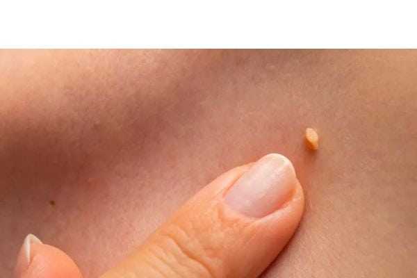 Θηλώματα: Tι είναι και γιατί βγαίνουν στο δέρμα; (Εικόνες)
