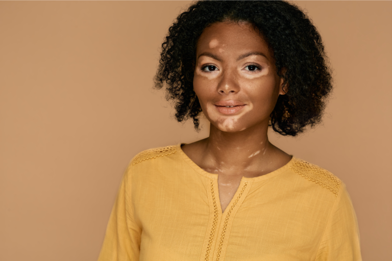 Vitiligo: what is it and what are the first symptoms?