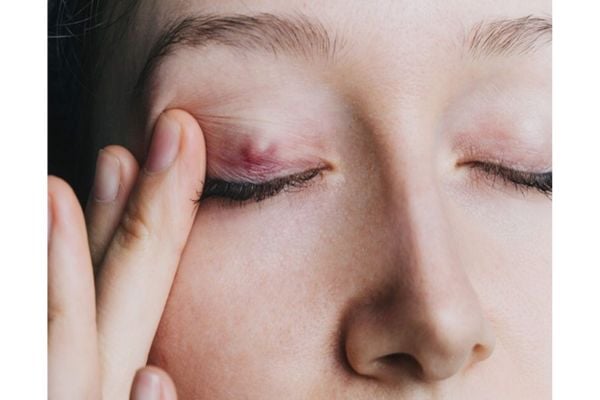 Chalazion: how does it go away and how long does it last?