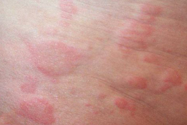 Stress rash: photos & treatment