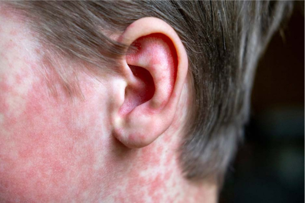 Measles Symptoms, Treatment & Prevention Guide